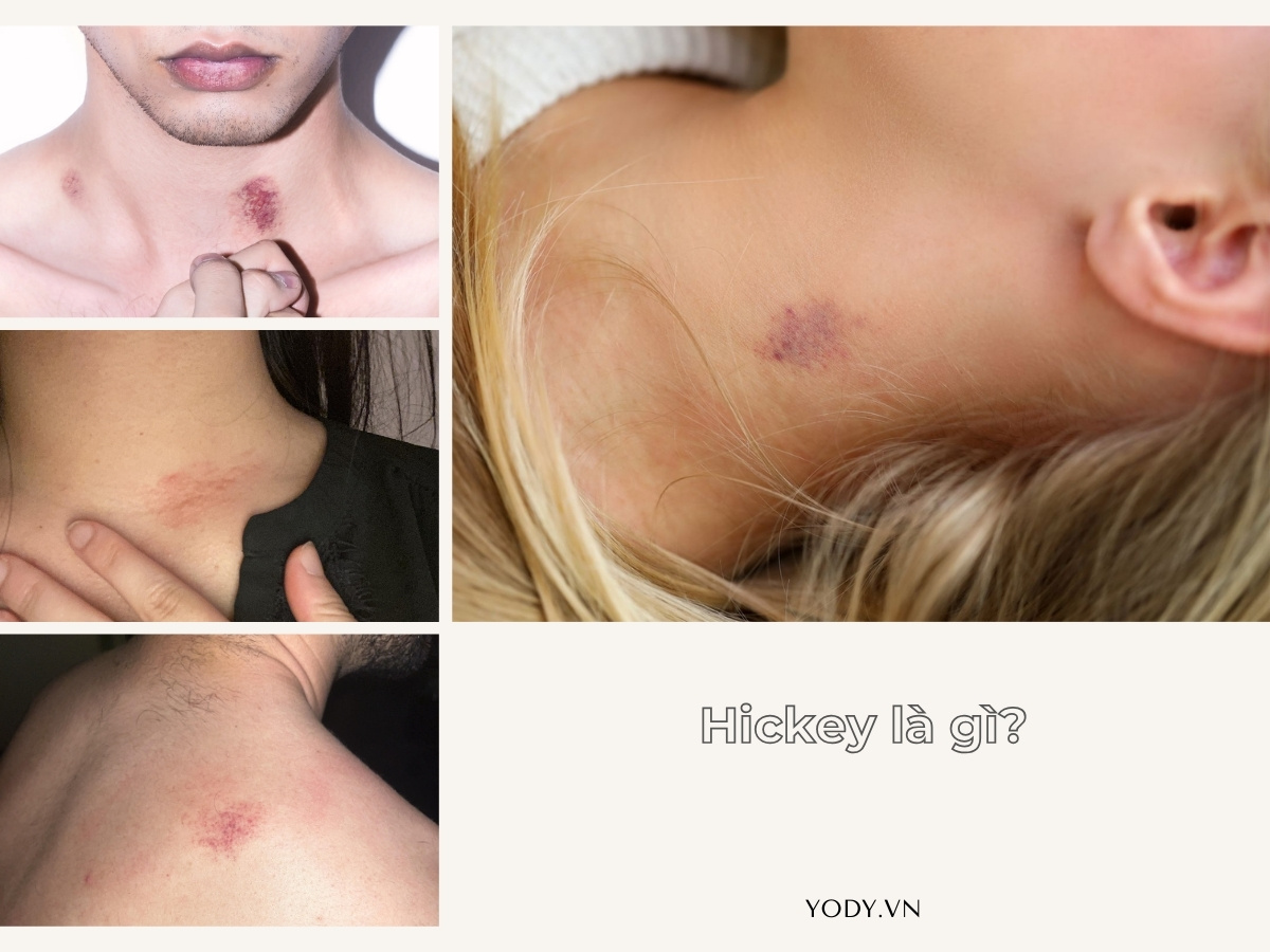 Hickey là gì? Vết hickey ở cổ có nguy hiểm với sức khoẻ không? | Yody